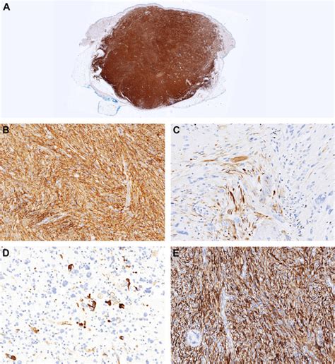 Superficial Cd34 Positive Fibroblastic Tumor Surgical Pathology Clinics