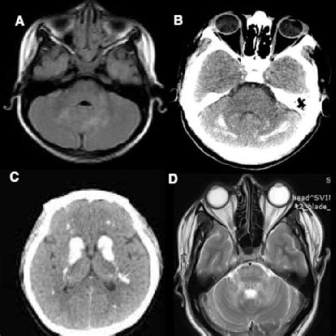 A Mri Brain T2 Weighted Image Wi Showing Symmetric Hyperintensities