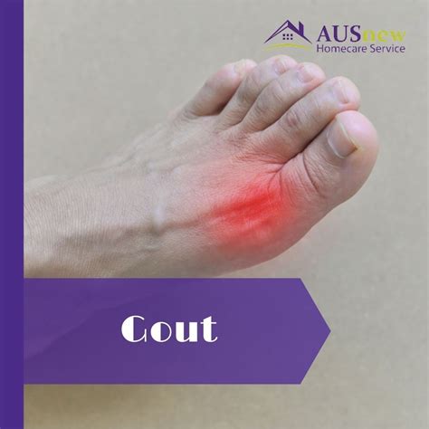 Gout Symptoms And Causes Artofit