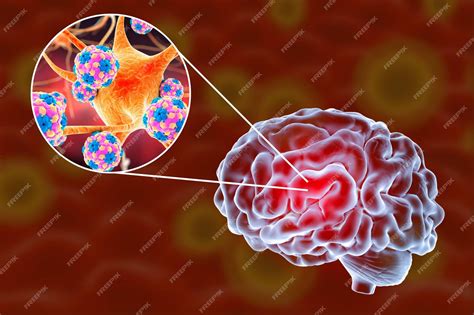 Premium Photo Viral Encephalitis 3d Illustration Showing Brain And