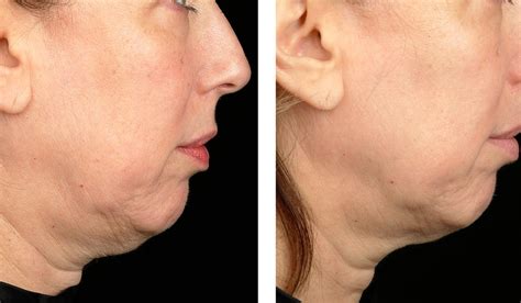 Thermage Before And After Non Surgical Skin Tightening Results