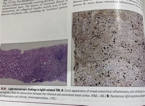 Retroperitoneal Fibrosis Histology
