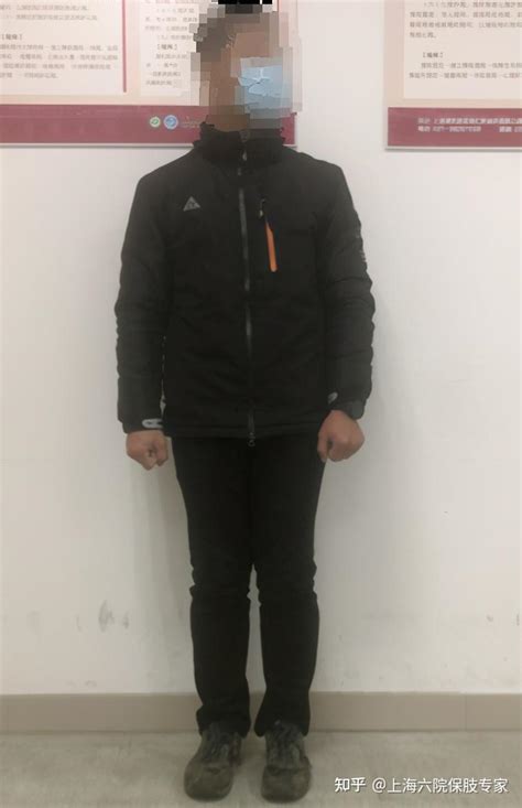 O型腿的救星胫骨外翻截骨术上海六院保肢专家文根 知乎