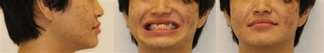 Composite Clear Aligner Treatment In A Pseudo Class Iii Malocclusion
