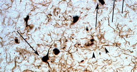 Visual Spatial Dysfunction Arena