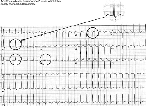 Reentrant Arrhythmias Thoracic Key