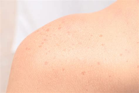 What Are Light Brown Spots On Skin