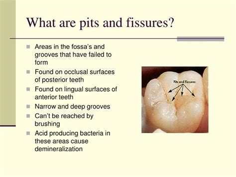 Ppt Pit And Fissure Sealant Application Powerpoint Presentation Id