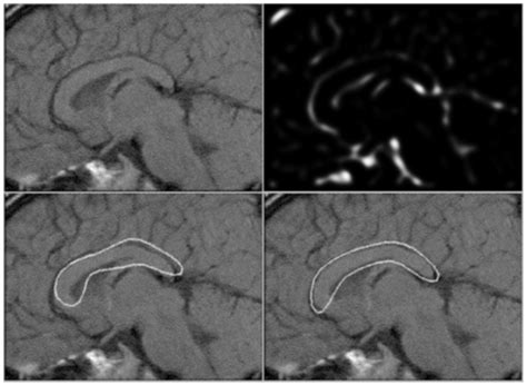5 Segmenting The Corpus Callosum From An Mr Midbrain Sagittal Image Download Scientific