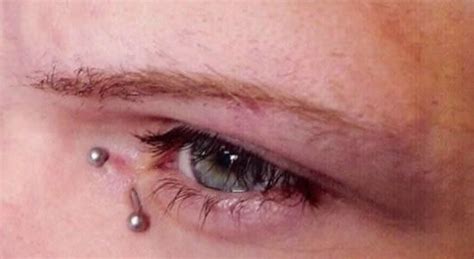 Eyelid Piercing Gone Wrong