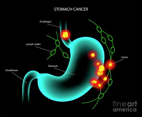 Stomach Cancer Photograph By Pikovit Science Photo Library Pixels