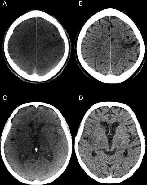A An Older Small Cortical Infarction Is Depicted On The Flat Detector Download Scientific