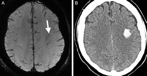Centrum Semiovale Stroke Mri