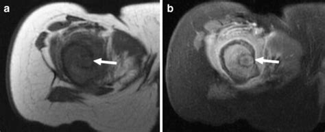 Axial T1 Weighted Pre Contrast A And Fat Saturated Post Contrast B