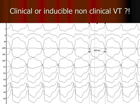 Ppt Ecg Diagnosis Of Ischemic Vt Powerpoint Presentation Free