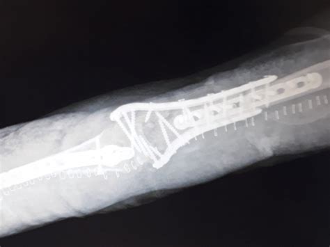 TRUE LOCK Distal Humerus Lateral Anatomic Plate TRUEMED Medikal