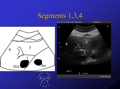 Liver Segments On Ultrasound Pptx