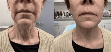 Best Options For Non Surgical Facelift In Washington Dc Metroderm Dc