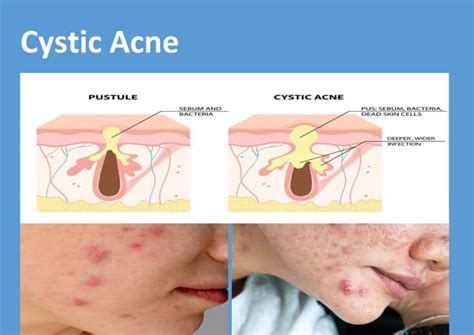 Cystic Acne Dermatologist Approved Guide To Treating Pdf