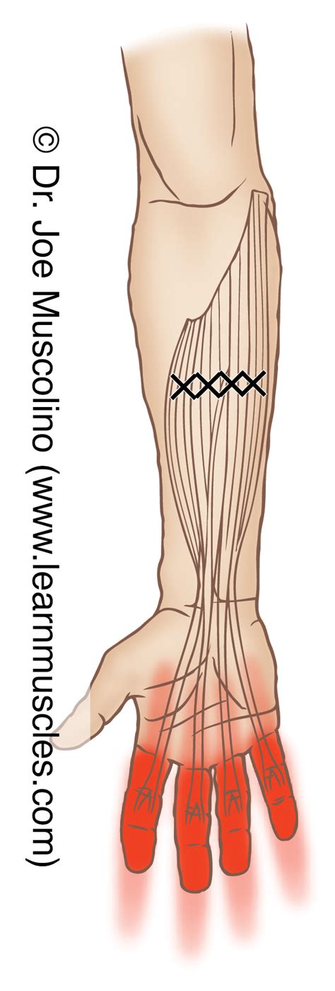 Flexors Digitorum Superficialis And Profundus Trigger Points Learn Muscles