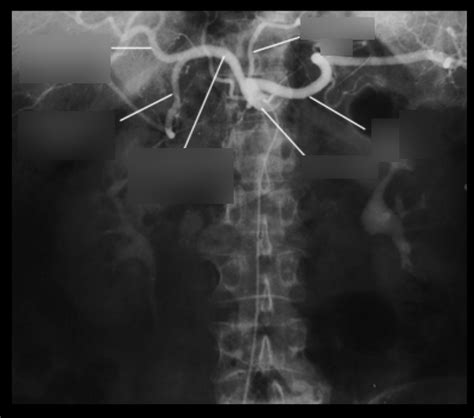 Block 2 Radiology Celiac Artery Angiogram Diagram Quizlet