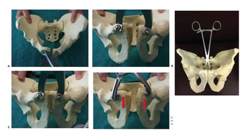 Pelvic Ring Fractures Ppt