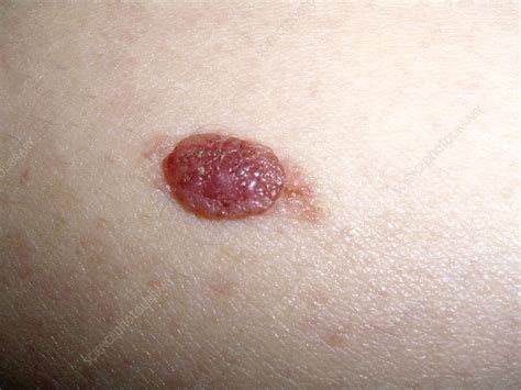 Congenital Nevus Stock Image C0611490 Science Photo Library