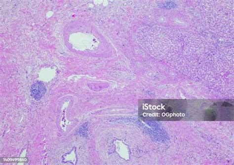 Kolangitis Sklerosis Primer Foto Stok Unduh Gambar Sekarang Amerika Serikat Amerika Utara