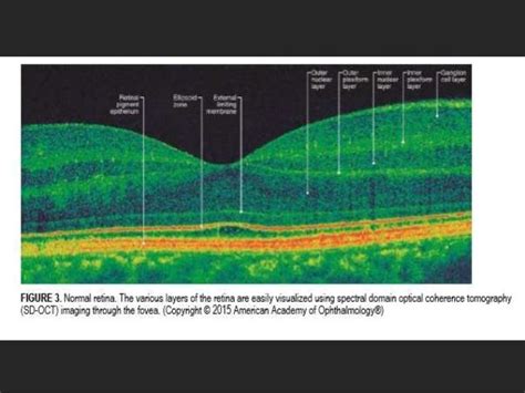 Epiretinal Membrane And Vitreomacula Traction In Updates By Panit Che…