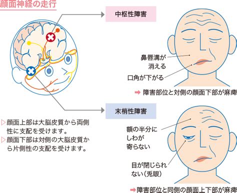 顔面神経麻痺 看護roo カンゴルー