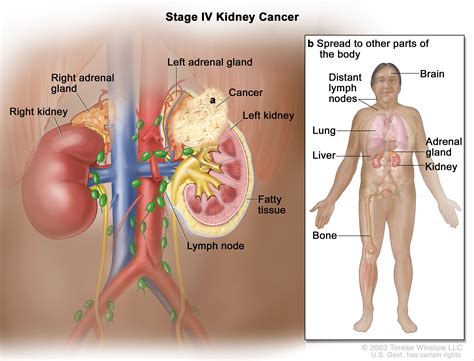 Adrenal Gland Tumor Symptoms
