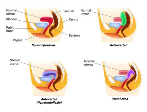 Retroverted Flexion Of The Uterus Myschoolexams Medvibe Insights