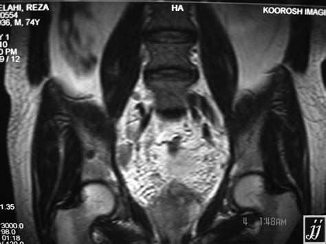 Prostate Metastasis Prostate Cancer Radiopaedia