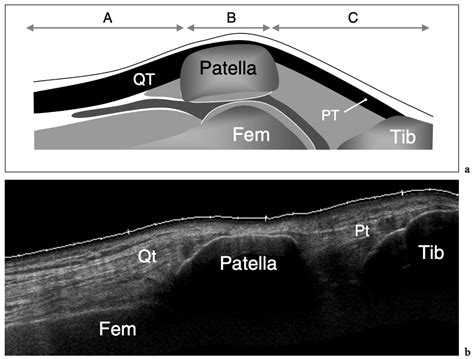 Msk Upper Left Elbow Anterior Joint Ultrasound Images