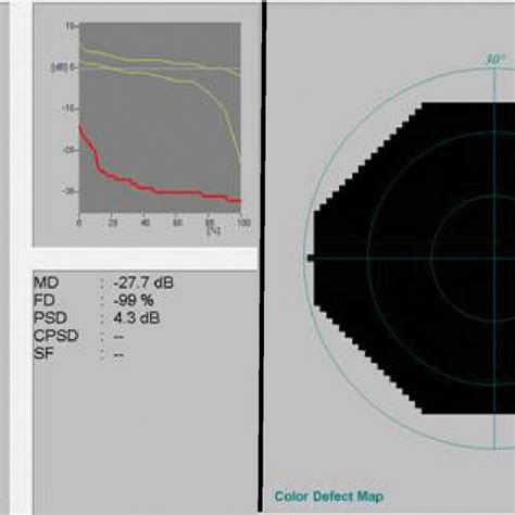 Automated Perimetry At Presentation Demonstrating Severely Disturbed