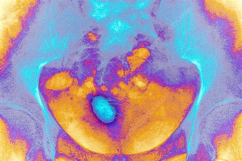 Vesical Calculus X Ray Stock Image C038 0144 Science Photo Library
