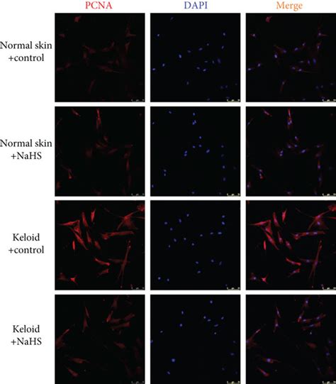 NaHS Inhibited PCNA Expression In Keloid Fibroblasts Skin Fibroblasts