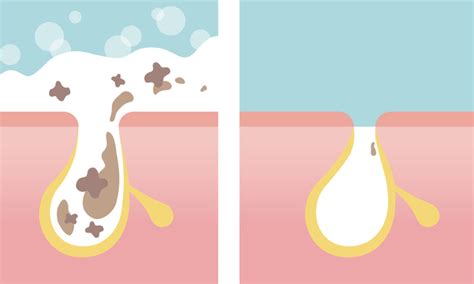 Sebaceous Filaments Vs Blackheads Whats The Difference And How To B