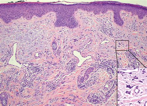 Case For Diagnosis Multinucleated Cell Angiohistiocytoma Anais Brasileiros De Dermatologia