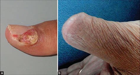 Pyogenic Granuloma Nail
