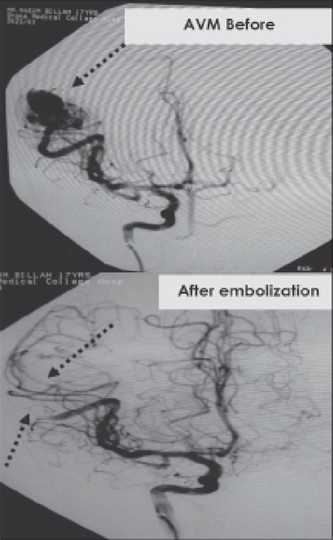 Cerebral Dsa Shows A Large Avm In Right Mca Branches Which Completely