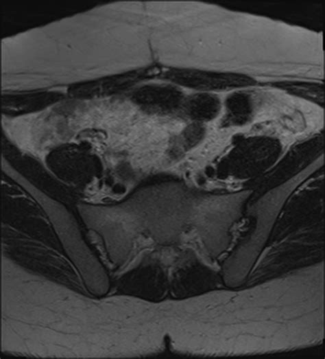 Filebicornuate Unicollis Uterus Radiopaedia 79468 92593 Axial T2 1