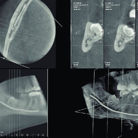 Multi Planar Reconstruction In Mandibular Region Download Scientific