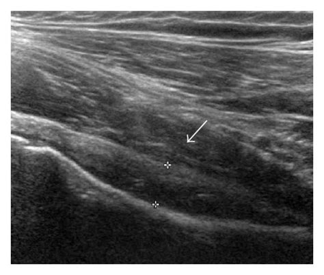 14 Year Old Girl With Intra Articular Osteoid Osteoma Of The Right