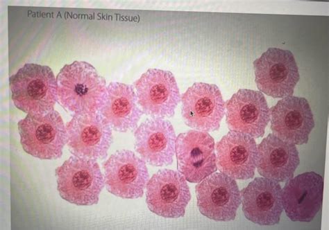 Solved Patient C Normal Breast Tissue Patient A