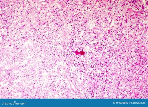 Liquefactive Necrosis Of The Human Brain Light Photomicrograph Stock