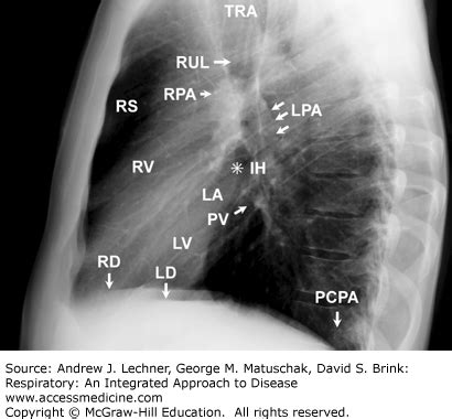 Lateral Chest Xray Anatomy Lung Imaging Methods Indications