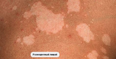 Как выглядит отрубевидный лишай у человека фото
