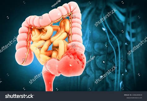Colon Cancer Colon Disease 3d Illustration Stock Illustration 2266284819 Shutterstock