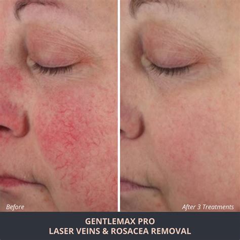 Effective Vascular Lesion Treatment In Montreal Reimagine Clinic